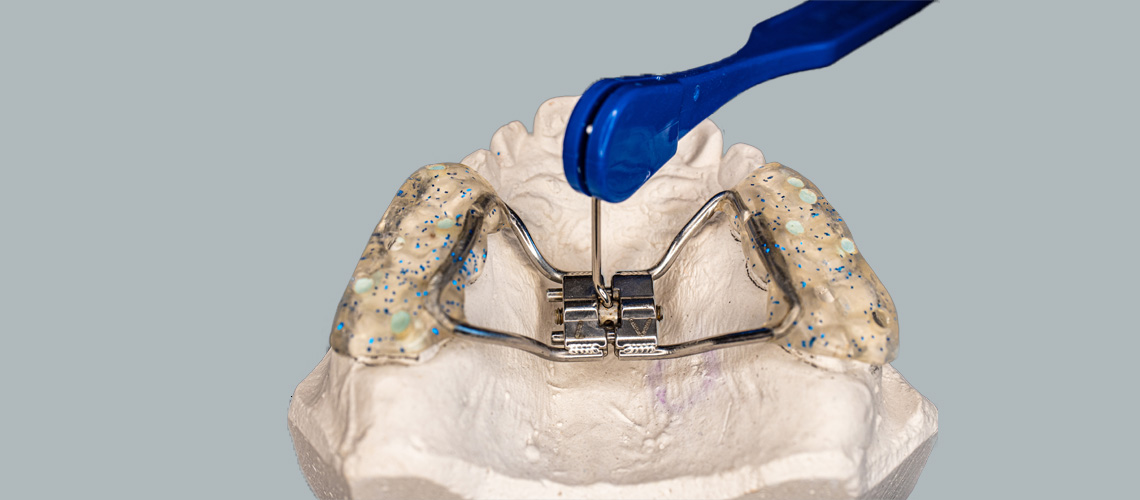 Orthodontic Palatal Expander | When Is a Palatal Expander Needed and ...